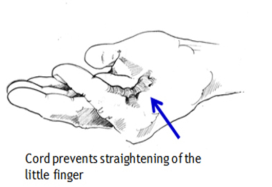 Hand Conditions | The British Society for Surgery of the Hand